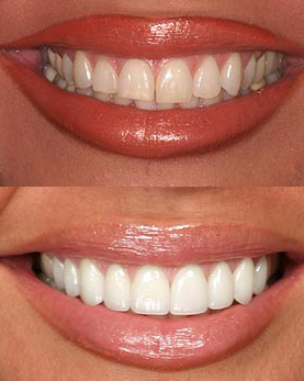 Good Veneers Vs Bad Veneers
